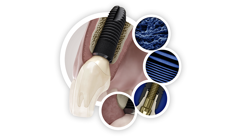 Simplicity without compromise with the Astra Tech Implant System EV ...