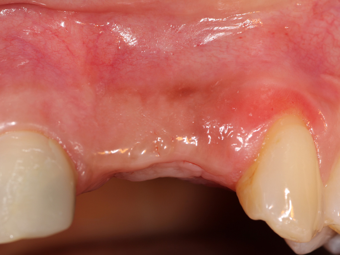 Use of a decalcified cortical bone plate to aid in lateral ridge ...