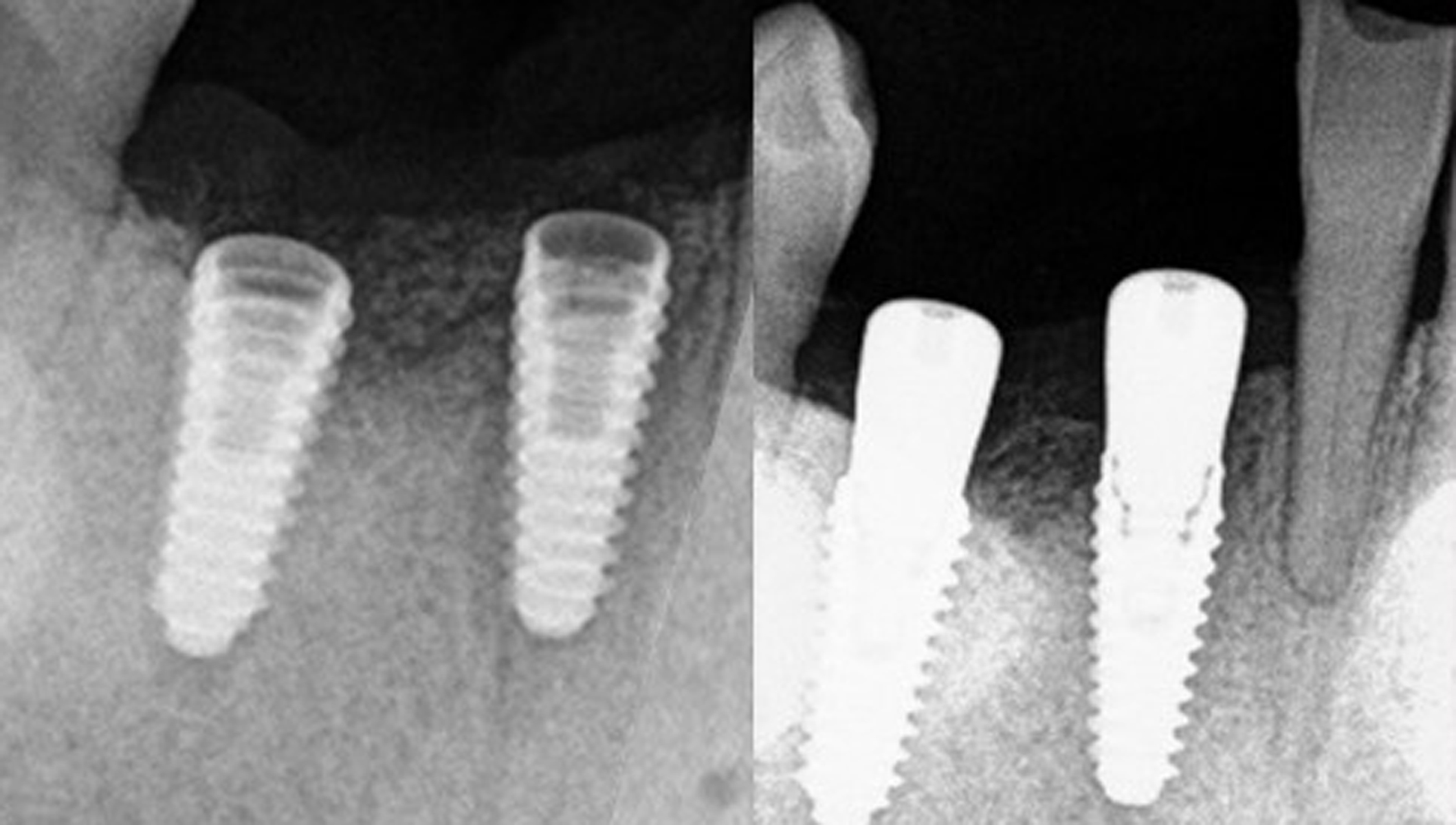 Dental News - An in-office-fabricated implant surgical guide corrected ...