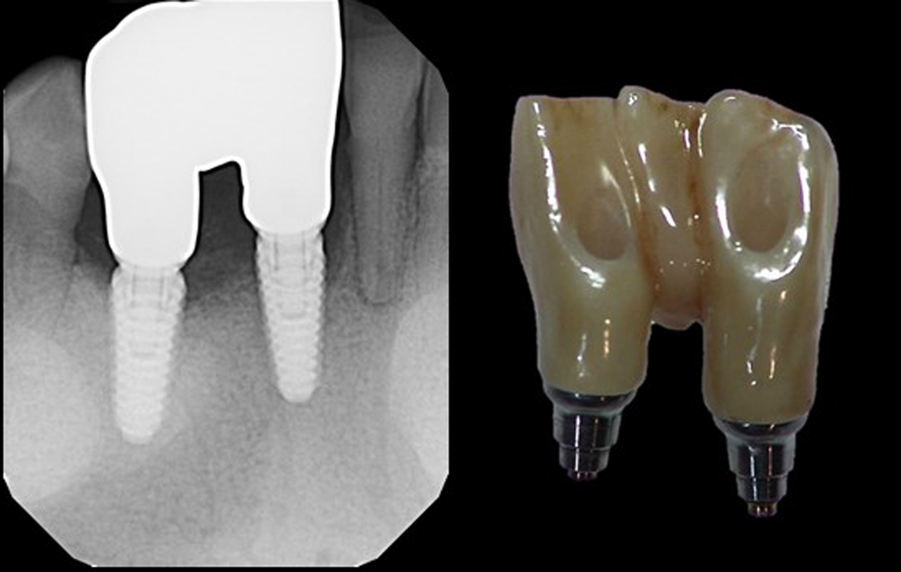 Dental News - An in-office-fabricated implant surgical guide corrected ...
