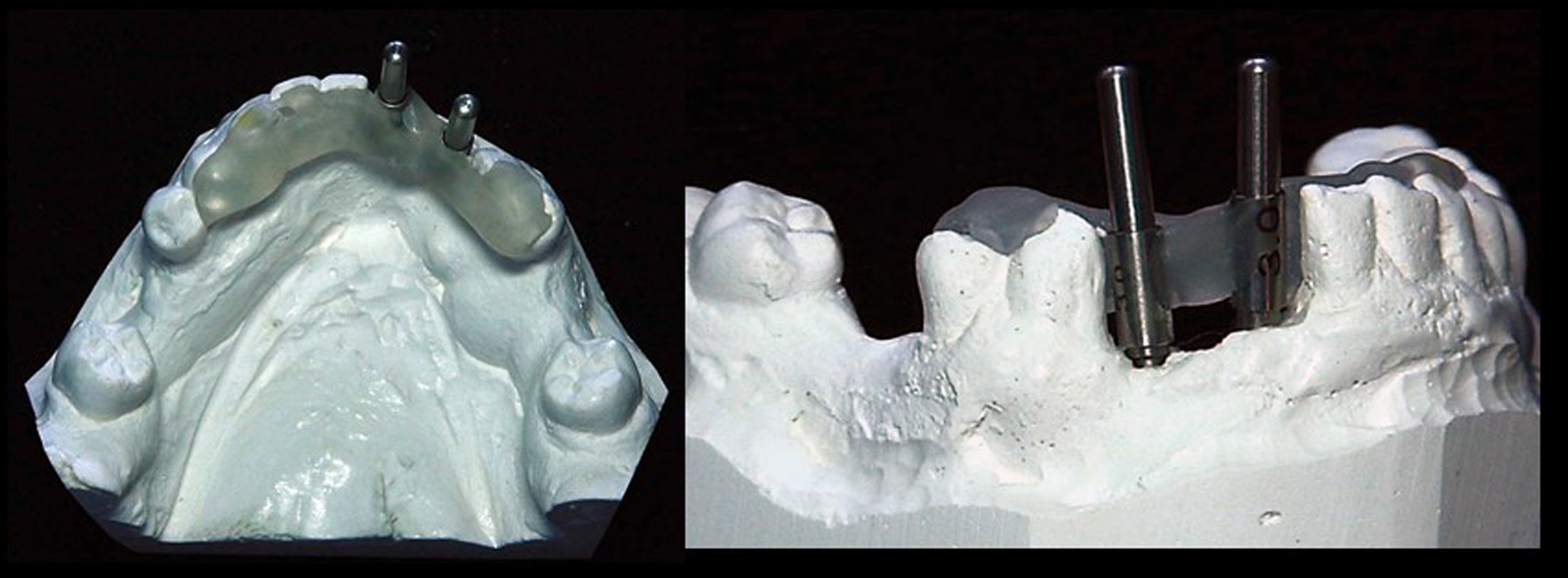 Dental News - An in-office-fabricated implant surgical guide corrected ...