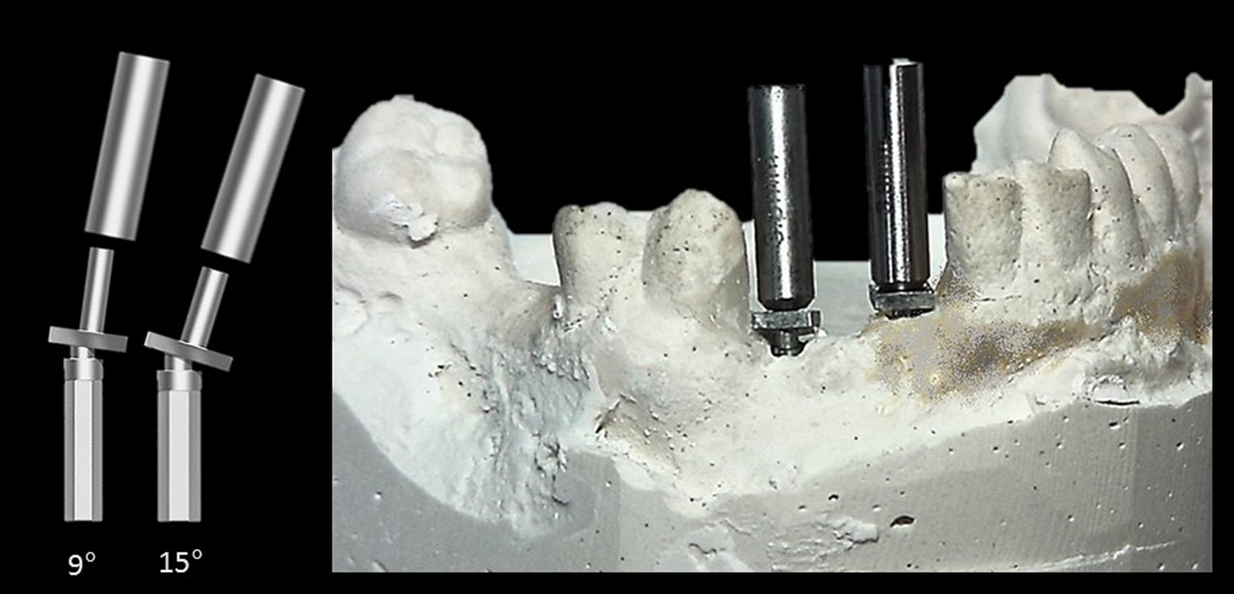 Dental News - An in-office-fabricated implant surgical guide corrected ...