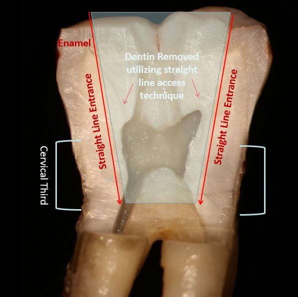 Conservative restorative-driven endo: Preserving tooth structure while ...