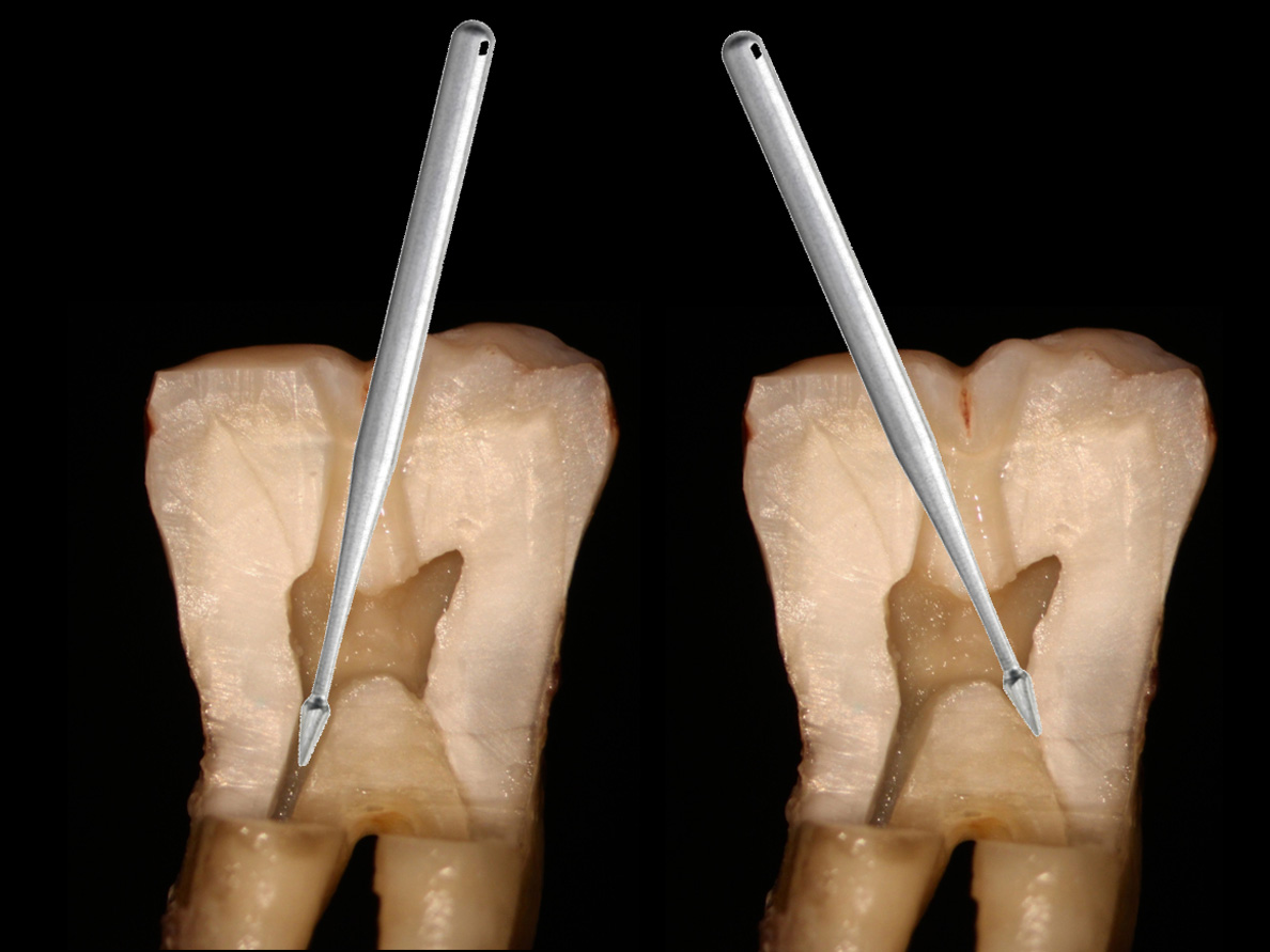 Conservative restorative-driven endodontics