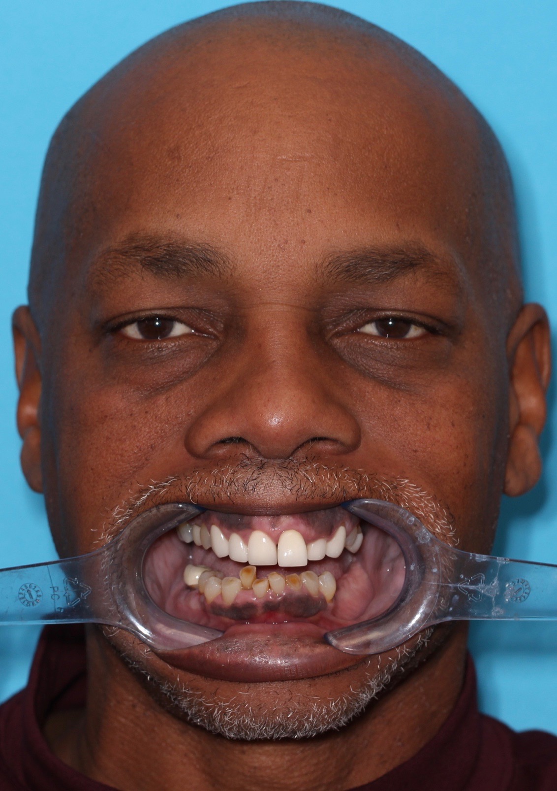 Predictable aesthetic success with a digital workflow