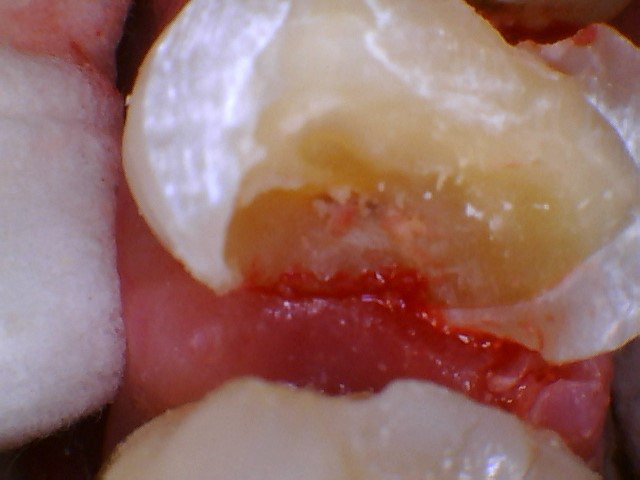 Laser treatment of pulpal exposure