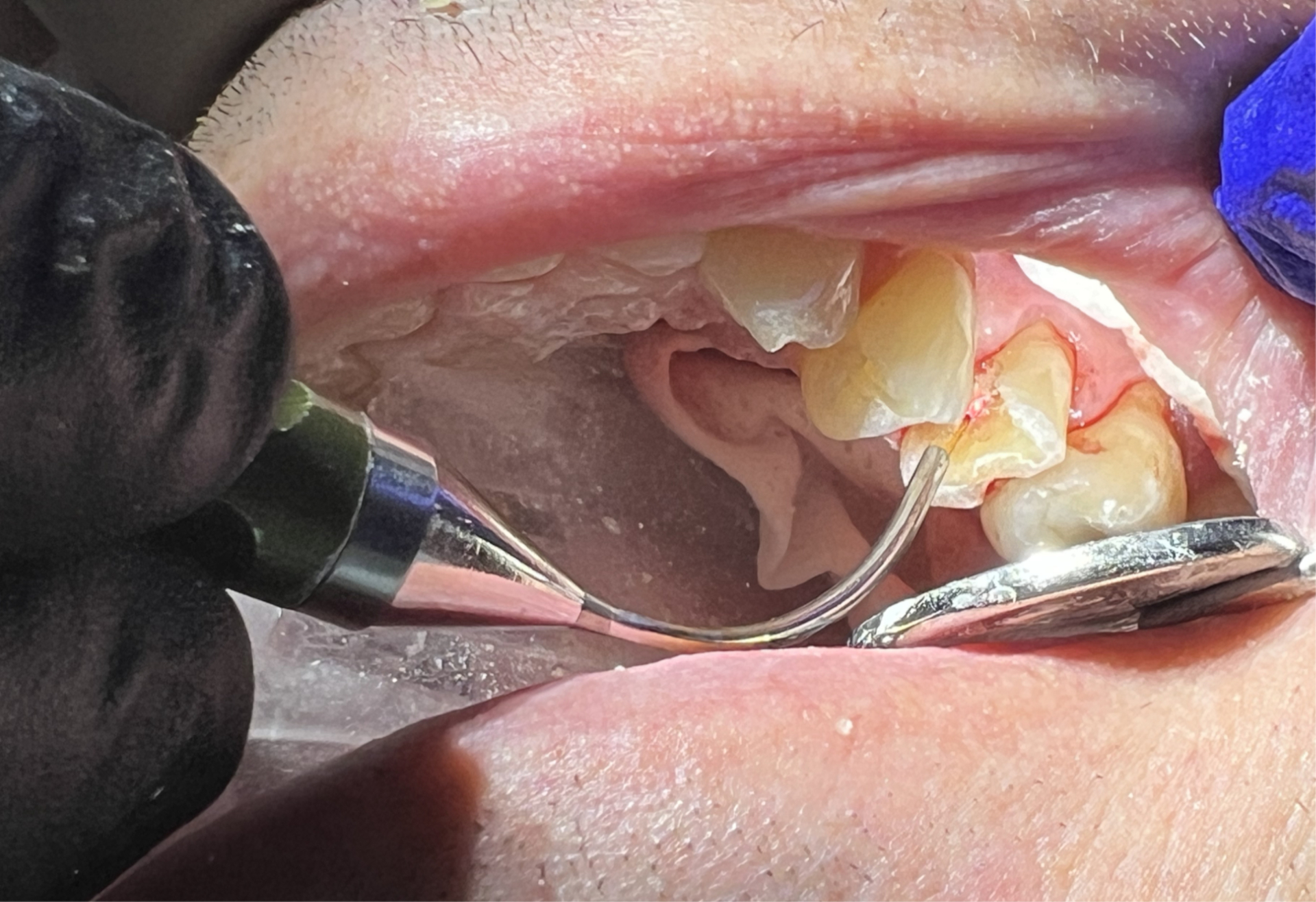 Laser treatment of pulpal exposure